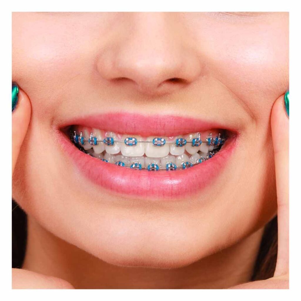 Types of Braces – Hyderabad's Best Dental Clinic & Awarded Aesthetic ...