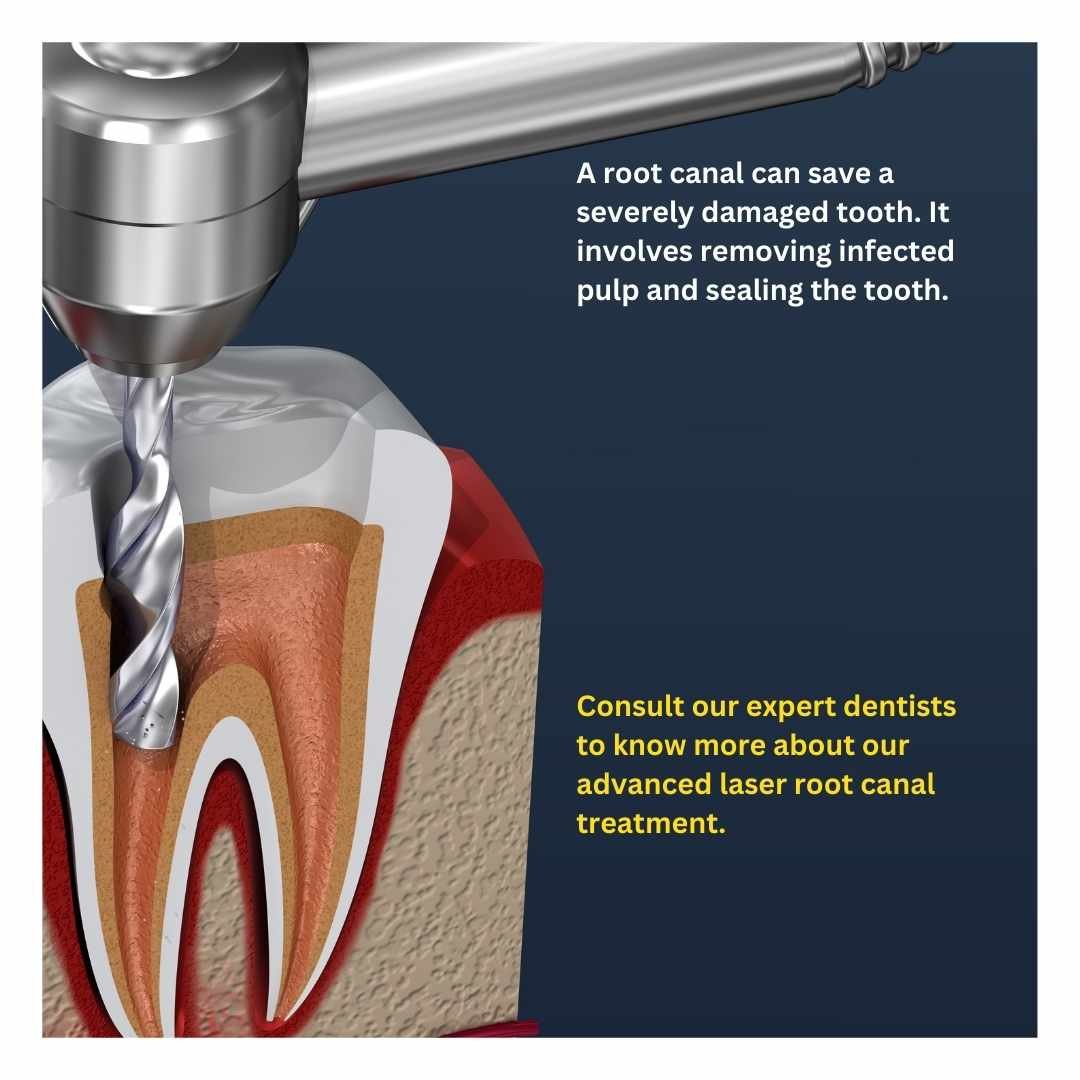 #1 Best Root Canal Treatment in Hyderabad India | Kondapur & KPHB
