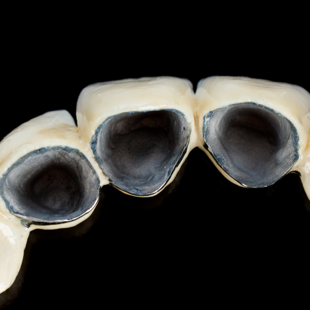 5 Different Types of Dental Crowns and cost involved | Smile Design and ...