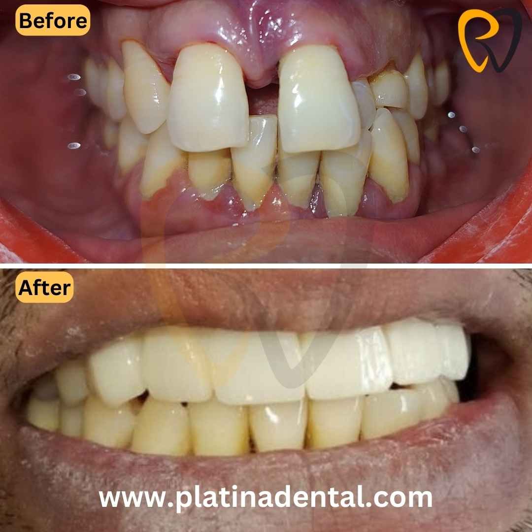 #1 Best Smile Design in Hyderabad | Kondapur & KPHB | Platina Dental