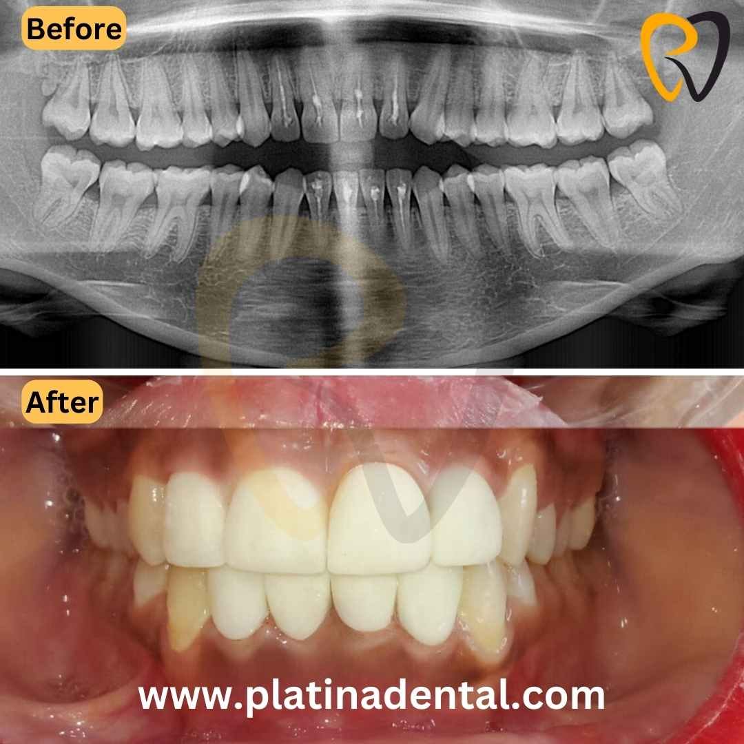 #1 Best Smile Design in Hyderabad | Kondapur & KPHB | Platina Dental