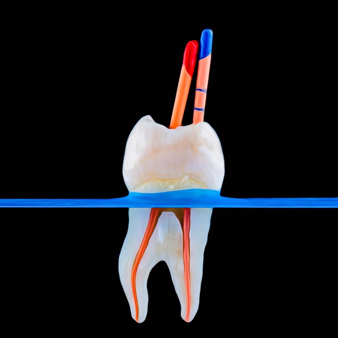 Best Advantages of Single Sitting Root Canal Treatment | Platina Dental